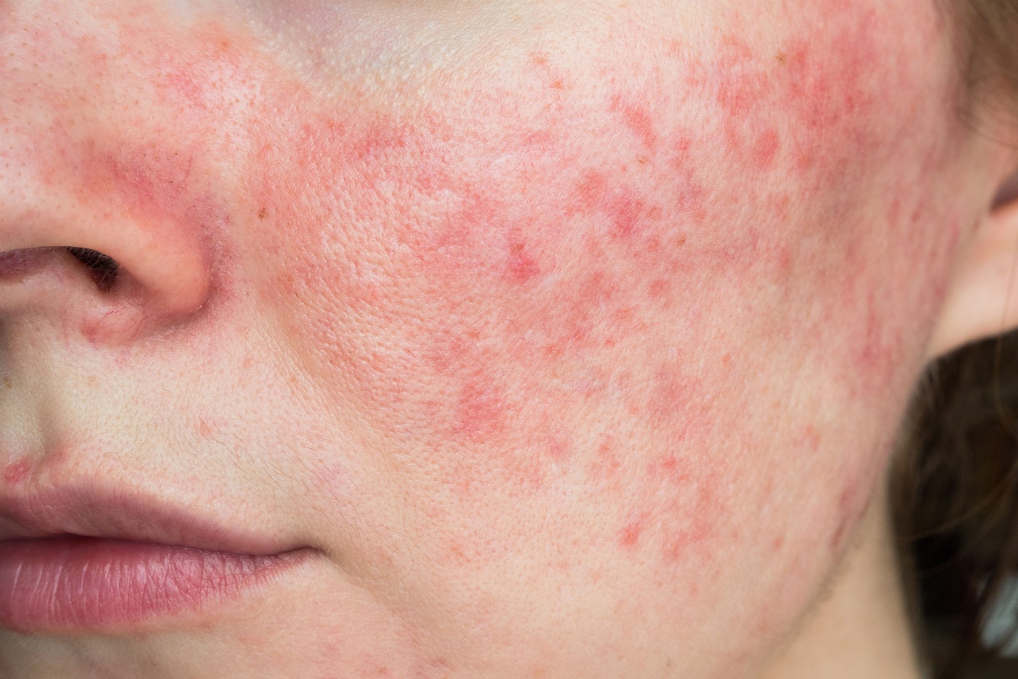 Red Blotchy Skin on Face: What It Is and How to Get Rid of It